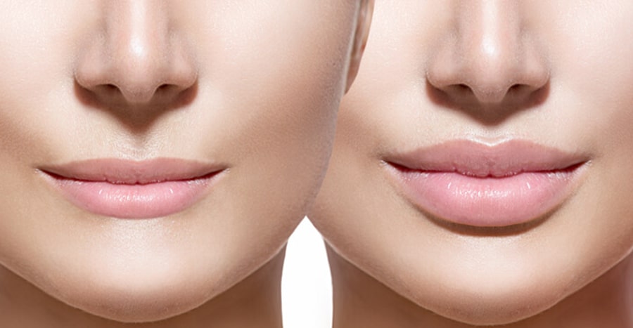 Restylane Fillers - Dermatologist in Atlanta, Georgia